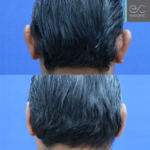 Ear Reshaping | Facial Surgery | evoclinic