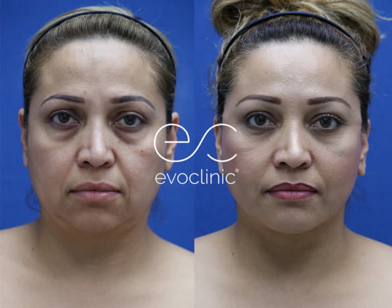 Facelift | Facial Surgery | evoclinic