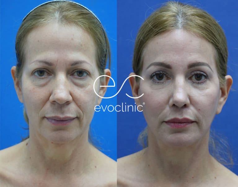 Facelift | Facial Surgery | evoclinic