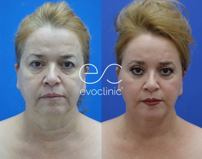 Facelift | Facial Surgery | evoclinic