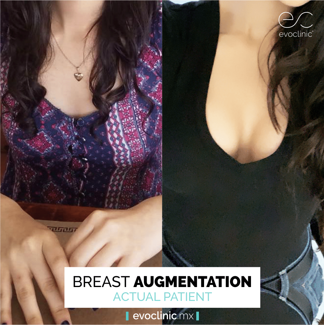 Aumento De Senos Antes Y Después Del Procedimiento Evoclinic